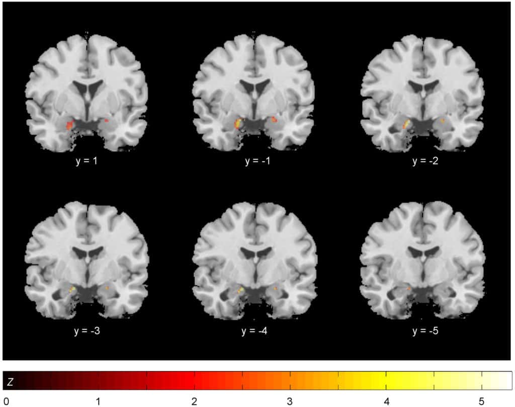 Structural but not functional neuroplasticity one year after effective ...